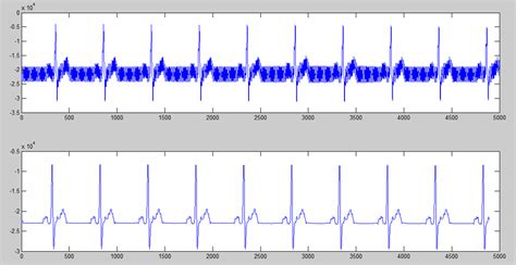 Ads1291 Ads1291 Ecg Signal Is Abnormal Data Converters Forum Data Converters Ti E2e