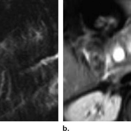 Distal Cbd Stricture And Choledocholithiasis In An 80 Year Old Man Mip