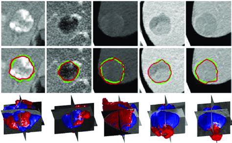 liver tumor segmentation using a unified lsm regularized with fuzzy download scientific diagram