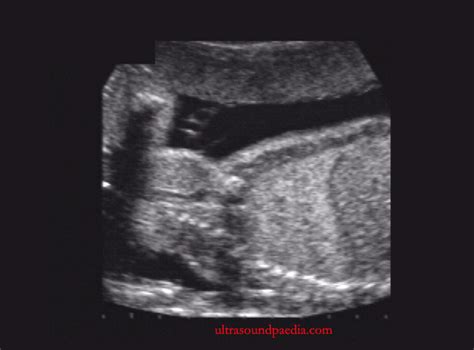 Goitre ULTRASOUNDPAEDIA