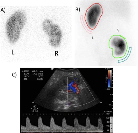 A Pre Operative Dimercaptosuccinic Acid Dmsa Renal Scintigraphy
