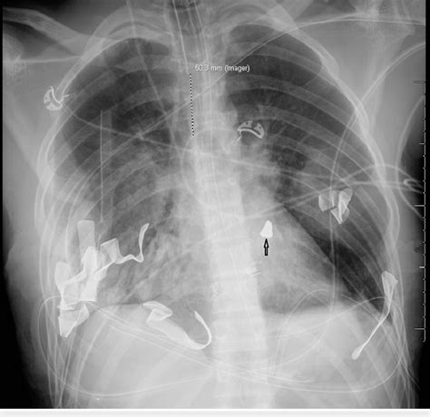 Chest X Ray Cxr Obtained On Post Operative Day 1 Figure 1 Shows Chest Download Scientific