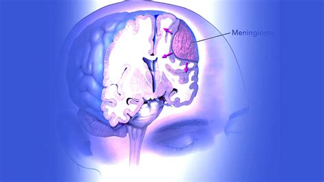 Meningioma Causes Symptoms And Treatments Mdmedicine