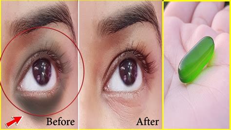 Apply Vaseline On Your Under Eye Dark Circles And See The Magic Remove Dark Circles In Just 3
