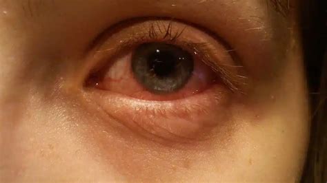 A Closer Look At Quick And Effective Bacterial Pink Eye Treatment