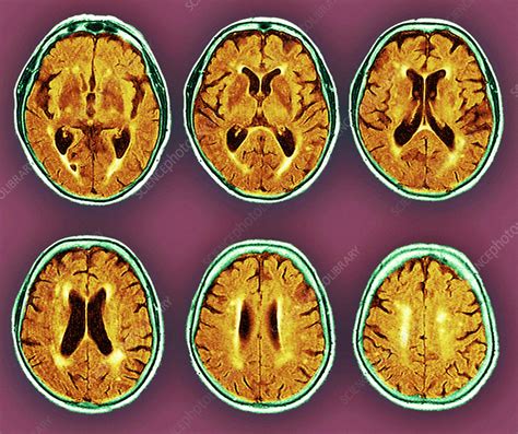 Dementia Mri Scans Stock Image M140 0435 Science Photo Library