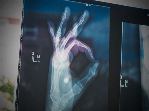 Maintaining Bone Health A Guide To Checking Your Bone Density Nirog Bharat