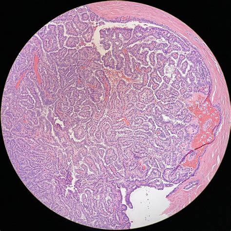 Papillary Thyroid Carcinoma Ptc Is The Most Frequent Thyroid Cancer
