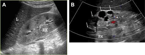 Ultrasound Of The Upper Urinary Tract Radiologic Clinics