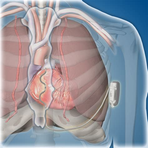 Extravascular Implantable Cardiac Defibrillator Surgery International