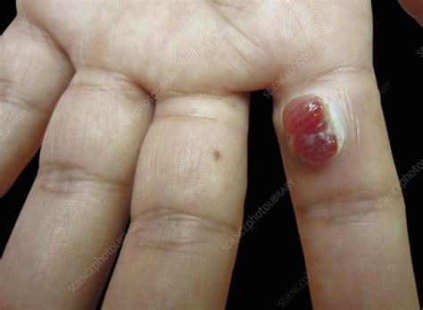 Ada Code For Removal Of Pyogenic Granuloma At Marshall Hite Blog