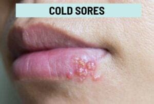 Cold Sores Pictures Of What They Look Like And Symptoms