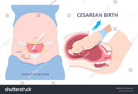 Cesarean Section Diagram