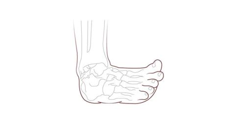 Brostrom Procedure How Surgeons Tighten Loose Ankle Ligaments