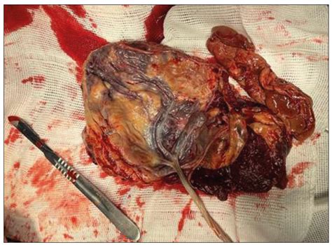 Massive Subchorionic Thrombohematoma Breus Mole Case Reports Ego Journal