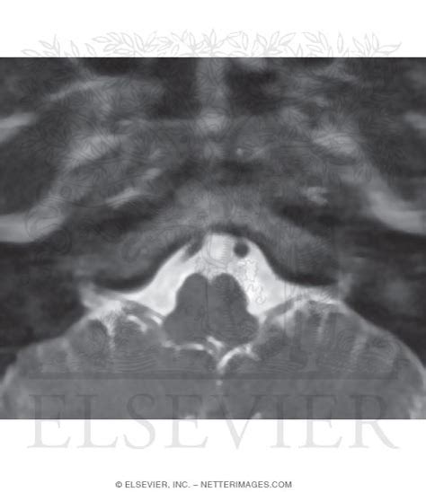 Cranial Nerves IX X XI