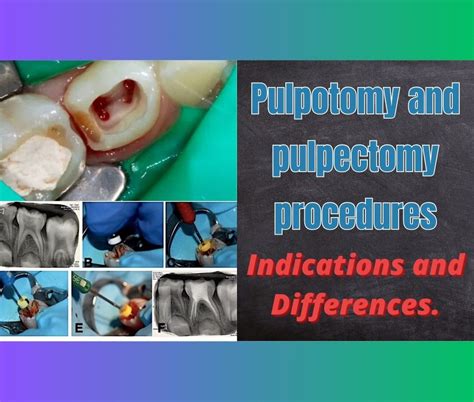 Pulpotomy And Pulpectomy Procedures Indications And Differences Odontovida