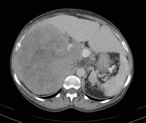 Retroperitoneal Leiomyosarcoma Pacs