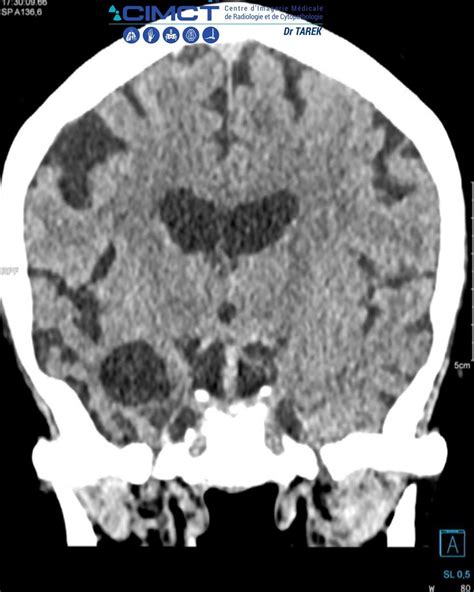 Case Day Ct Scan Frontotemporal Lobar Degeneration « Frontotemporal
