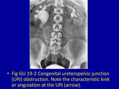 19 Obstruction Of The Ureter Pptx