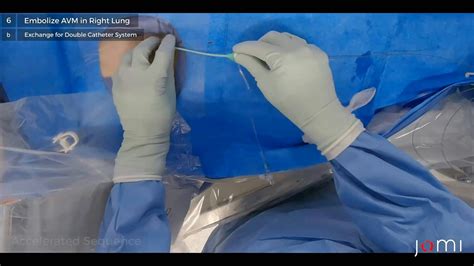 Pulmonary Avm Embolization Jomi