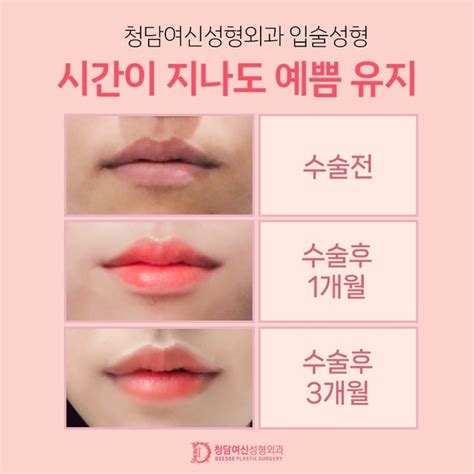 청담여신성형외과 코성형 입술성형 윤곽성형 눈성형 💜청담여신💜 청담여신코수술후기💜 Instagram