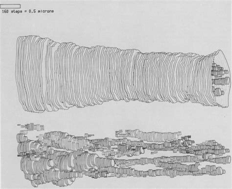 Reconstruction Of A Short Optic Tract Segment The Top Portion Of The