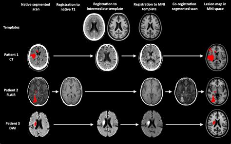 Brain Infarct Segmentation And Registration On Mri Or Ct For Lesion Symptom Mapping