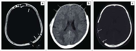 Axial Bone Window Ct Brain Image A Demonstrates A Left Parietal Download Scientific Diagram