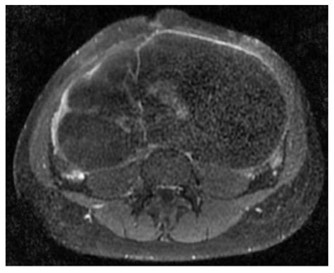 Giant Benign Struma Ovarii With High Grade Fever Elevated Ca 125 And