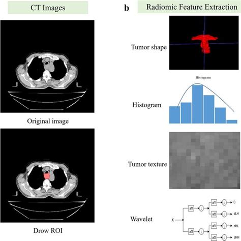 Radiomic Feature Extraction A The Regions Of Interest Roi Of Tumors Download Scientific