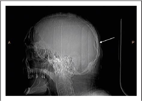 Simple Skull Fracture
