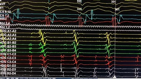 Hannah Hays On Linkedin Icm Vt Ablation With Initial Map Vt Activation Map Incessant Vt Hdgrid