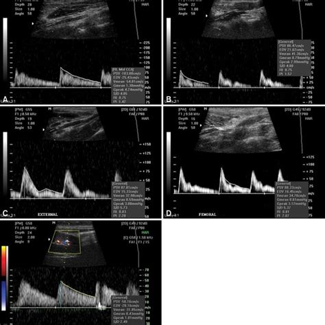 Representative Pulsed Wave Doppler Spectral Waveform Pattern For The Download Scientific