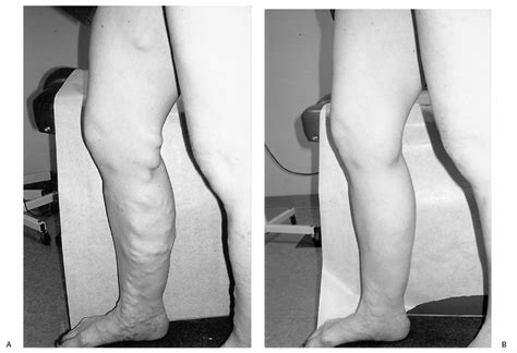 Saphenous Vein Ablation Radiology Key