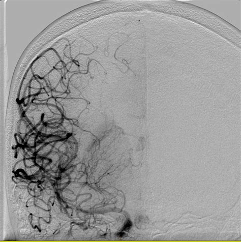 Reperfusion Scaleticistrokeendovascular