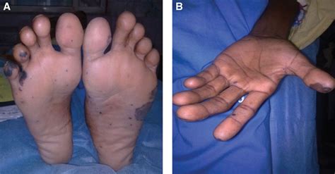 Osler Nodes Endocarditis