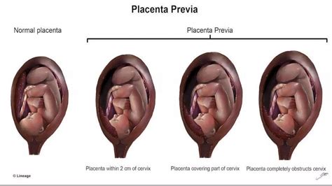 Placenta Accreta Spectrum Disorders Pptx