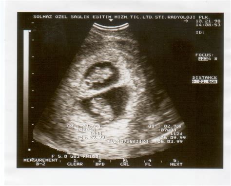 Heavy Implantation Bleeding Twins CRACKED