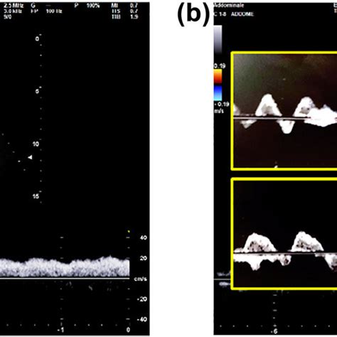 Spectral Doppler Pattern Of Iv Normal Triphasic Wave In Sovrahepatic Download Scientific
