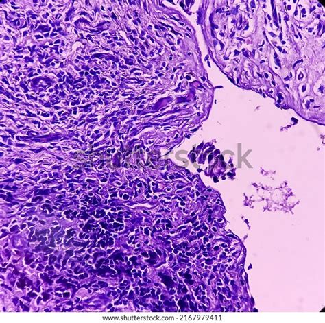 3 Imágenes De Hyperkeratosis Under Tongue Imágenes Fotos Y Vectores De Stock Shutterstock