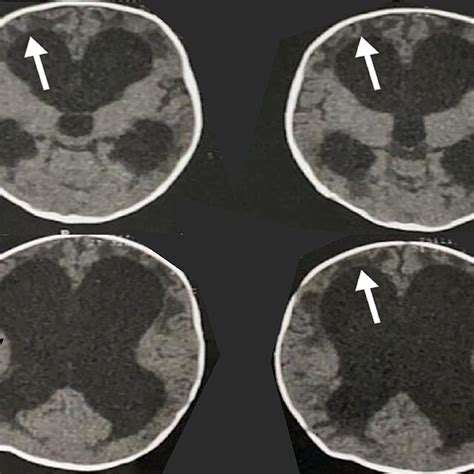 Axial Computed Tomography Ct Scan Shows Enlargement Of The Ventricles