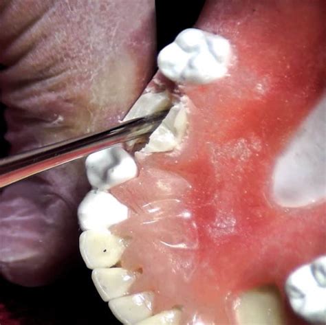 Upper First Molar Model Surgery Koerner Center For Surgical Instruction