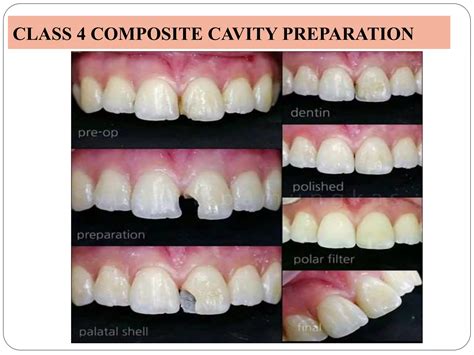Class Iii Iv V Cavity Preparations For Composites Selvi Pptx