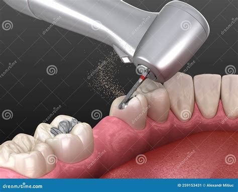 Amalgam Removing And Preparation For Ceramic Crown Placement 3D