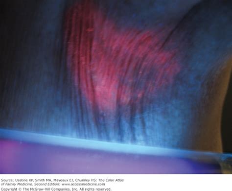 Erythrasma Basicmedical Key