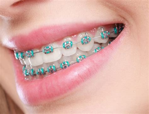 Retainers 101 Why Theyre Important After Braces Ogara Gilbert