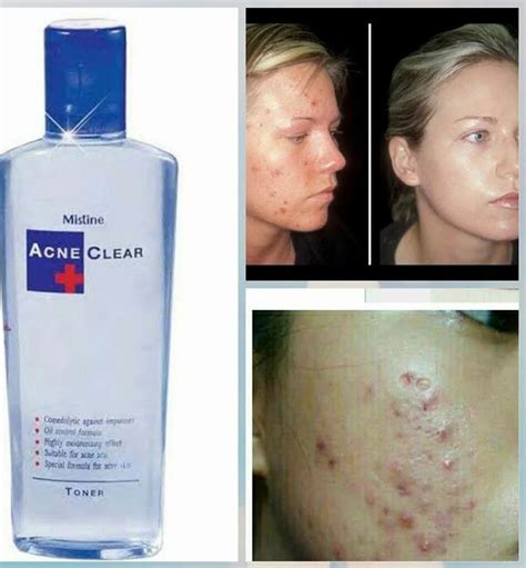 Mistine Acne Scar Clear Oil Control Facial Foam (85g.) at Rs 699 ...