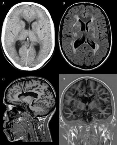 Ct And Mri Of Patient 1 A Axial Ct Brain Image Showing A Punctate Download Scientific
