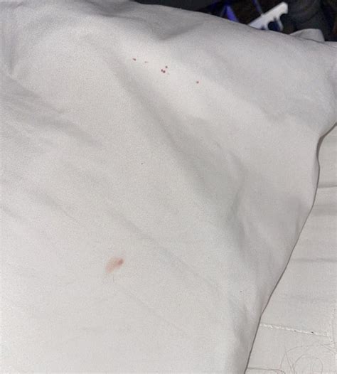 Is This Bed Bug Marks Rwhatsthisbug